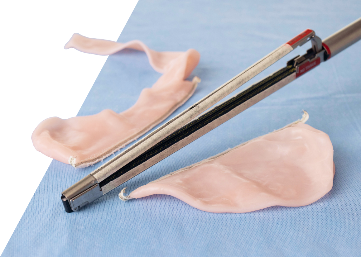 STAPLE-LINE REINFORCEMENT | Standard Bariatrics